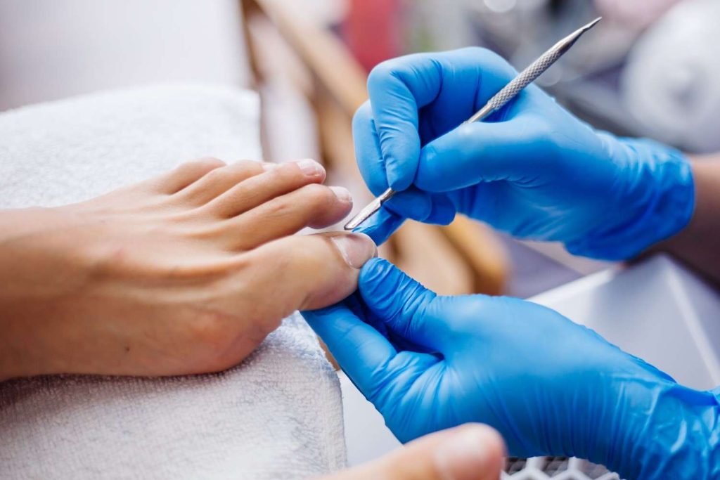 Ingrown Toenail Removal in Bangalore | Keza Clinic